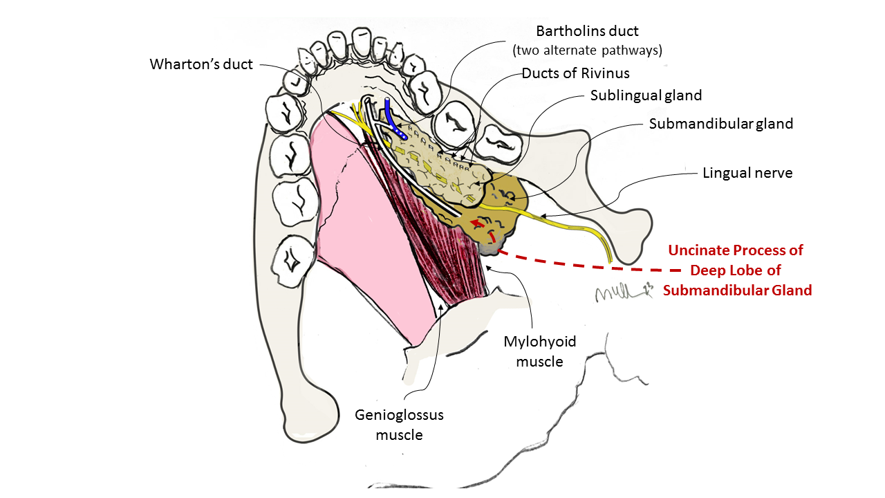 Submandibular Gland Anatomy: The Uncinate Process of the Deep Lobe | Iowa Head and Neck ...